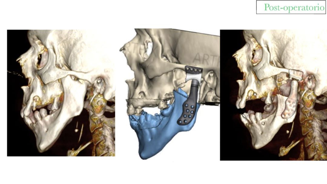 Puede abrir su boca nuevamente gracias a prótesis maxilofacial: Se ...